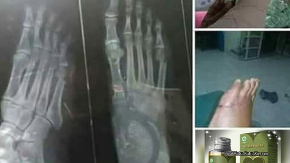 Testimoni Penggunaan Minyak Kutus Kutus Untuk Operasi Tulang Patah Dan ...